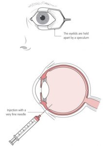 Macular Degeneration | The Eye Expert